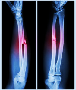 Fracture & Sprain Treatment in Rochester, NY | Orthopaedics